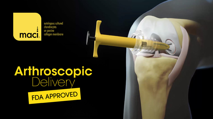MACI Arthro Instrumentation: An Exciting Development in Arthroscopic ...