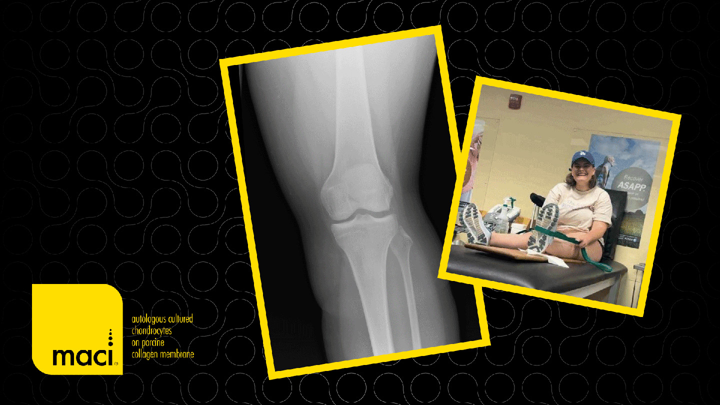 MACI Arthro Case: Exploring MACI Knee Cartilage Repair via Arthroscopic ...